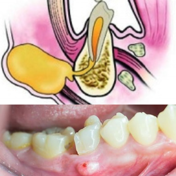 Zánět okostice (zubní váček) u dítěte – příčiny, příznaky a léčba | MOD ...